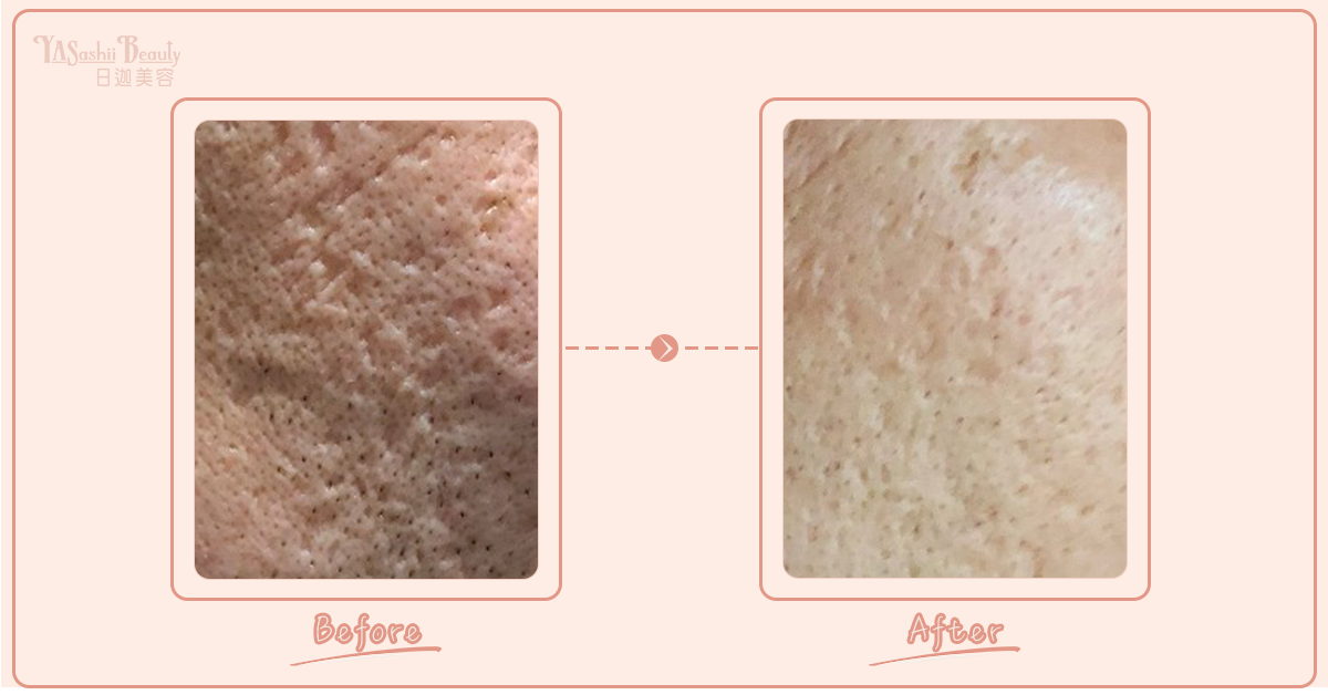 激活細胞嫩肌療程 - 日迦美容 Yasashii Beauty